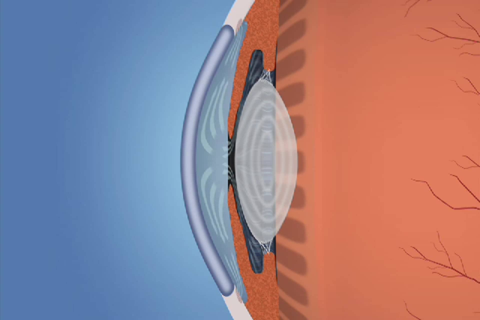 Glaucoma - What is optic nerve cupping from loss of nerve fibers?