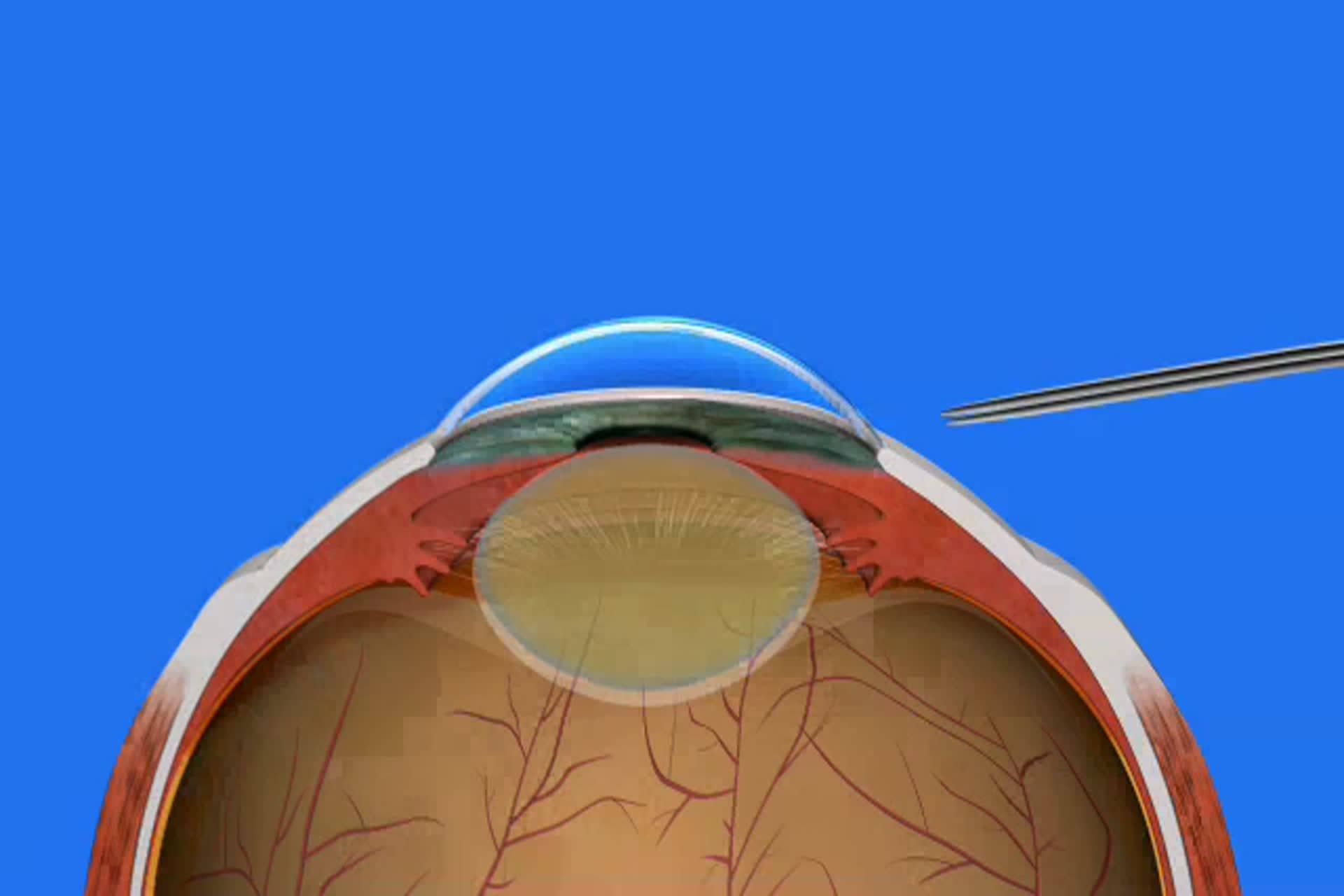 Cataract Surgery with Glasses Independence